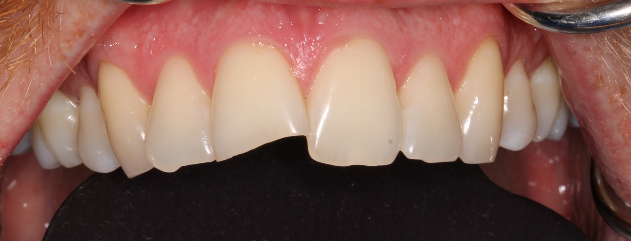 COMPOSITE BONDING - hornseydentalcentre