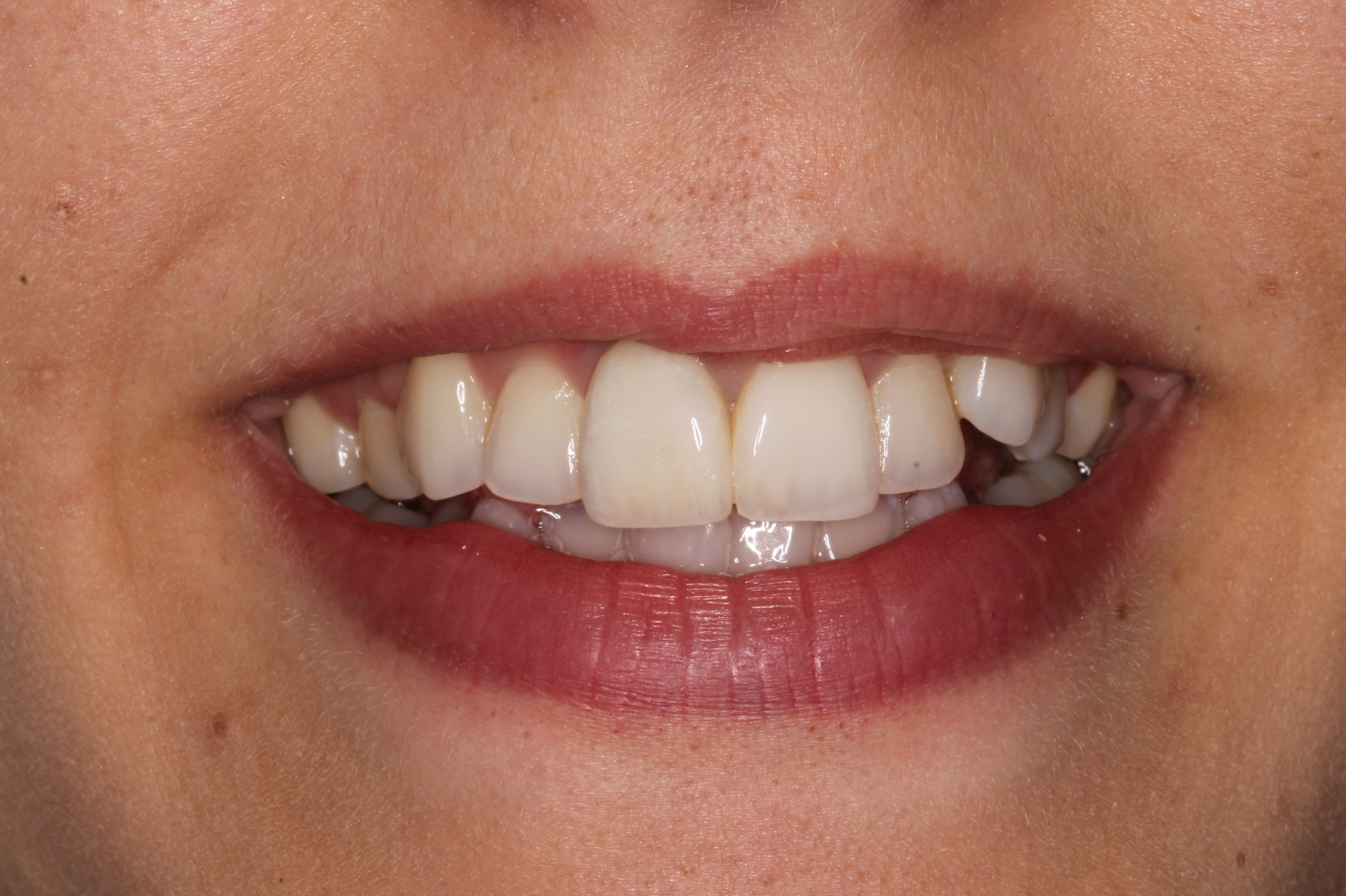 CROWN & BRIDGES - hornseydentalcentre