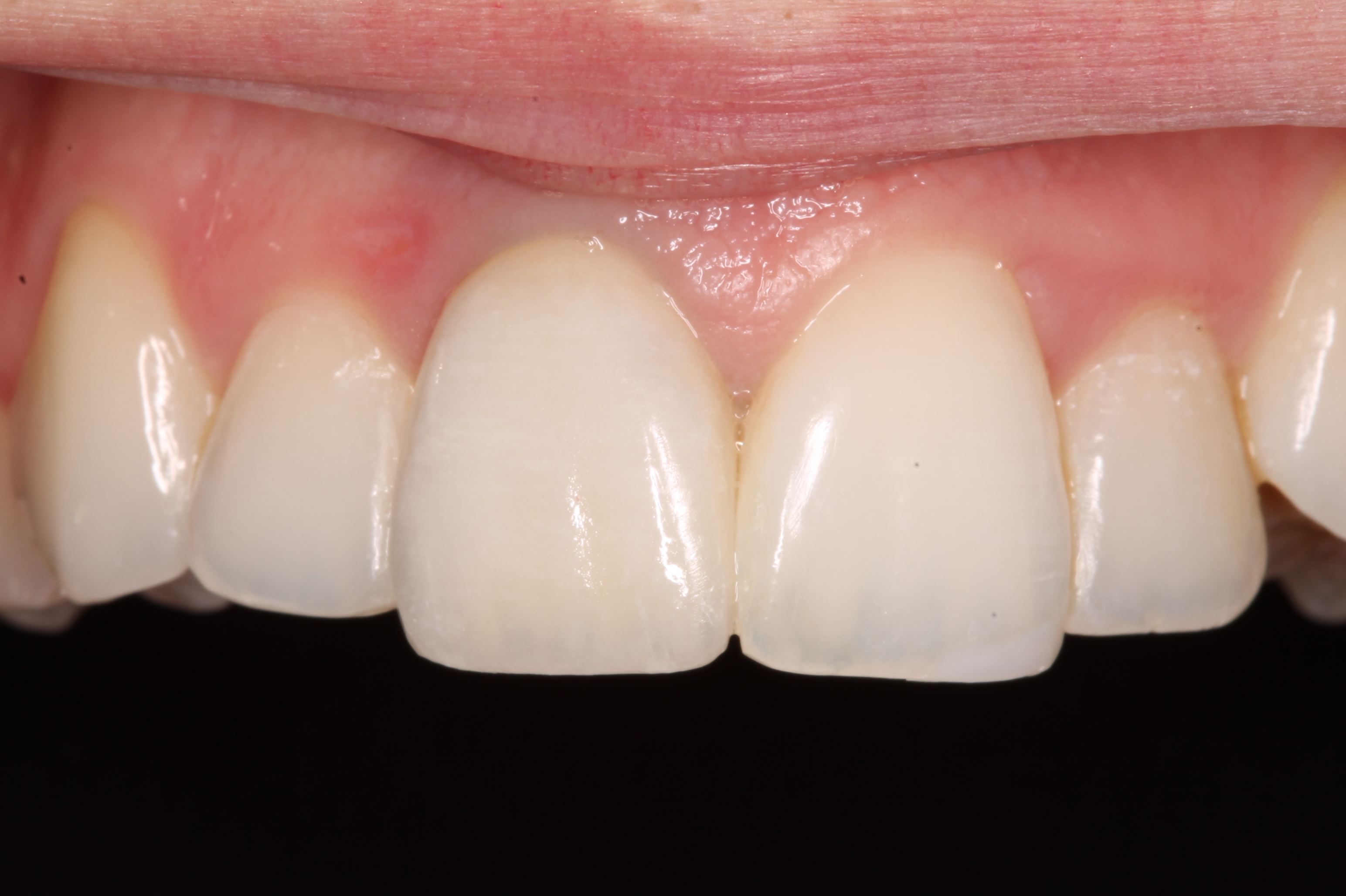 CROWN & BRIDGES - hornseydentalcentre