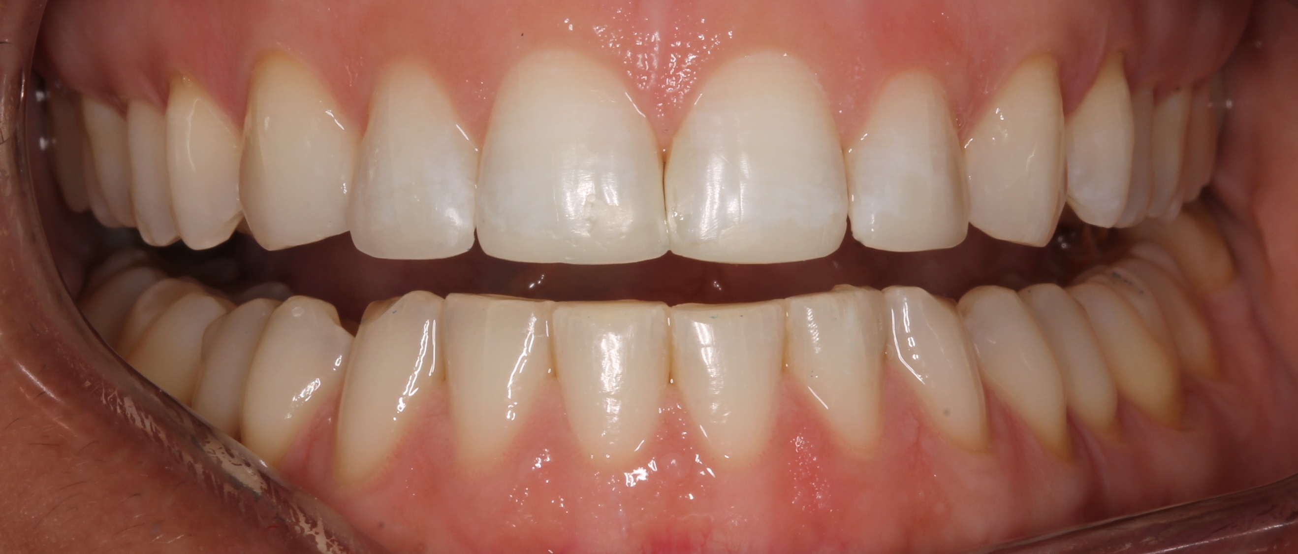 TOOTH WEAR - hornseydentalcentre