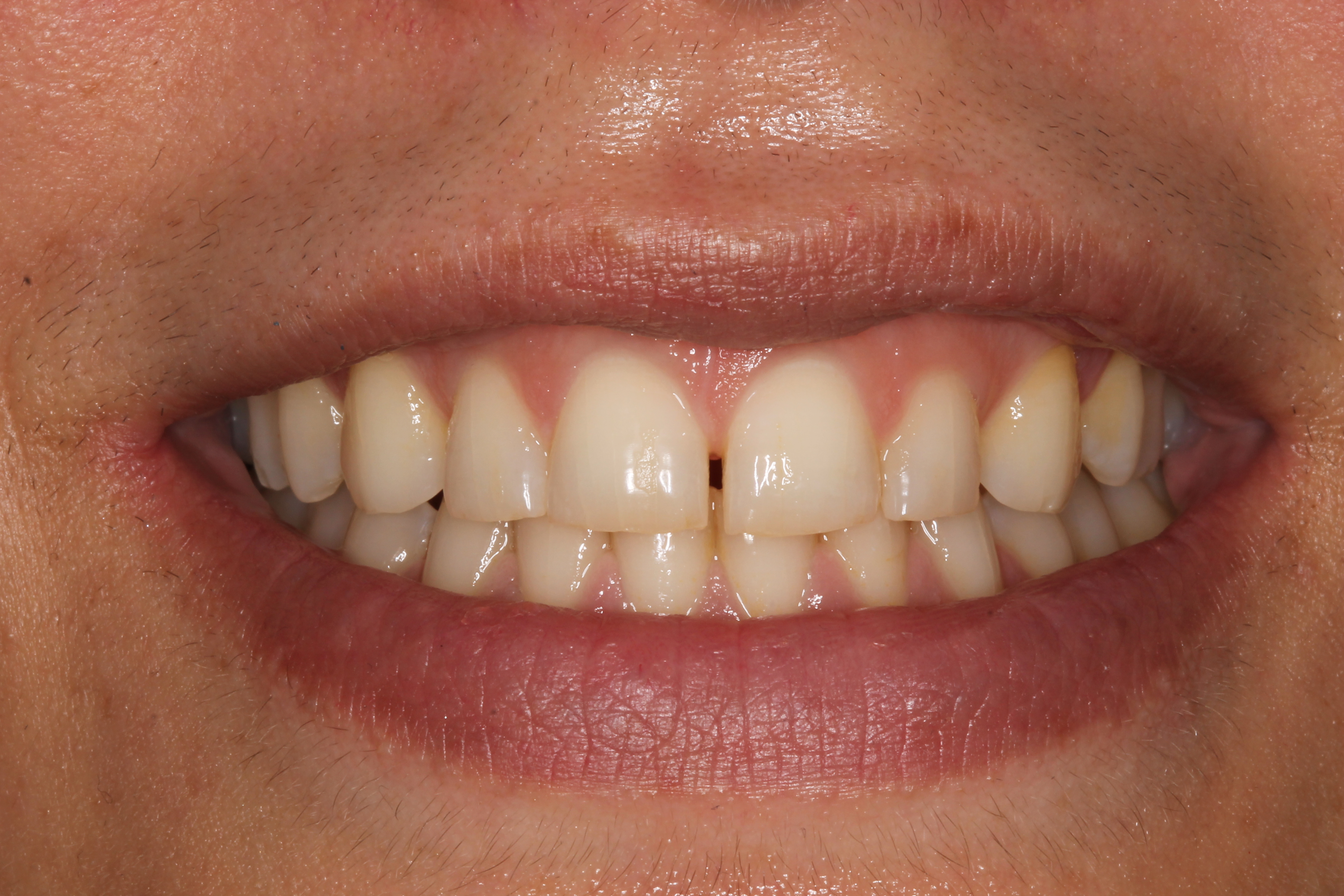 Tooth Wear Que Es at Marion Rosenthal blog